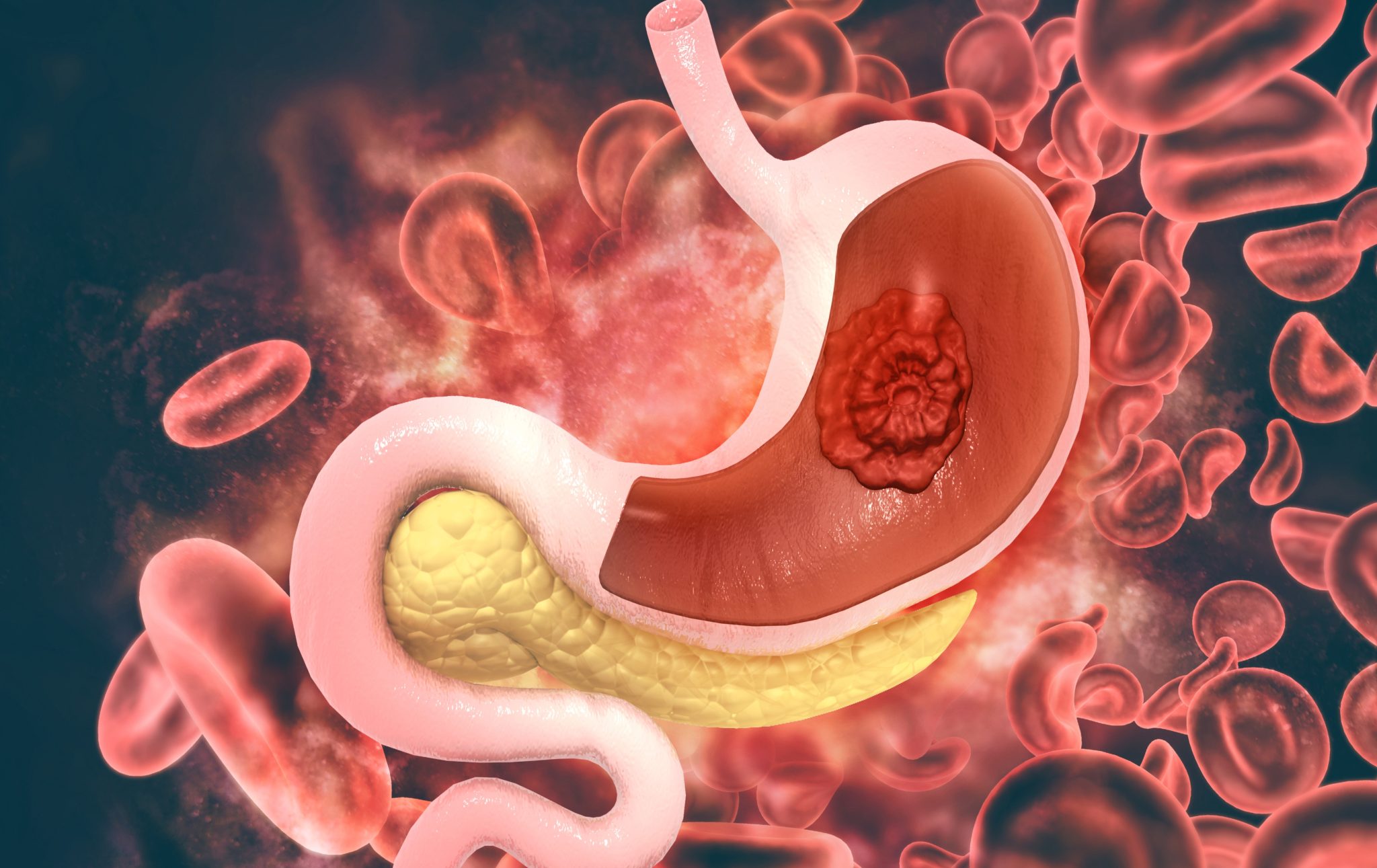 【胃抽筋】一文睇清胃抽筋成因、症狀及解決方法！